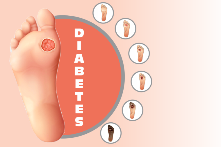 Diabetic Foot Syndrome: Symptoms, Risk Factors, Complications, and ...