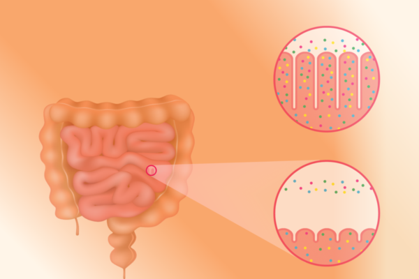 Pathophysiology of Celiac Disease: How it all begins? – The Health Quest