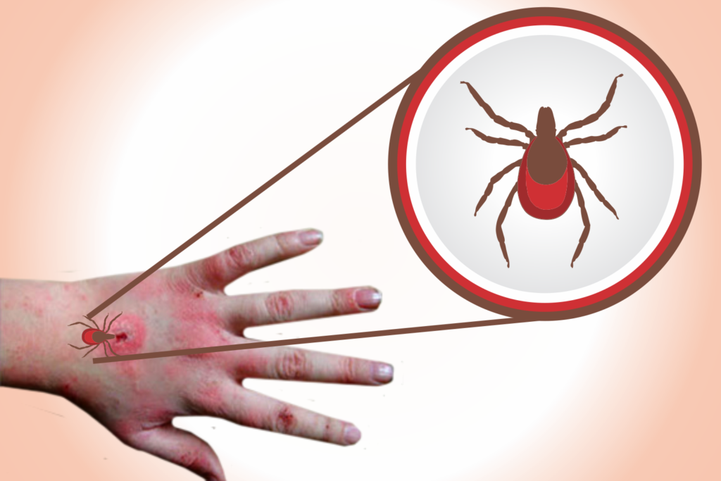 Scrub Typhus in Children – The Health Quest