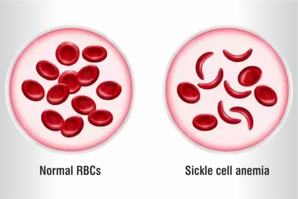 Combating sickle cell anemia – The Health Quest